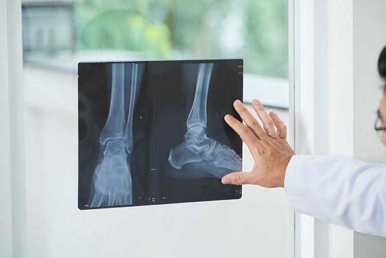 Cartiva Implant – Shield Justice Watch